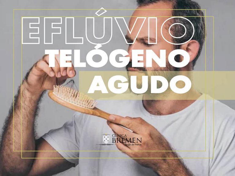 Eflúvio telógeno agudo | Clínica Bremen